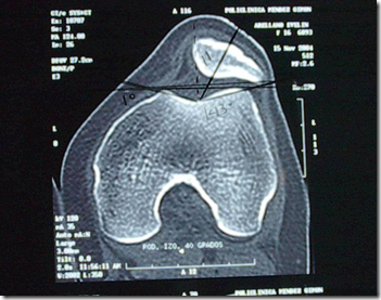 Ortopedia Valencia: Recopilación Condromalacia Rotuliana